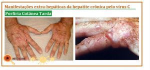 Hepatite C: o que você precisa saber. - Dra keilla Freitas