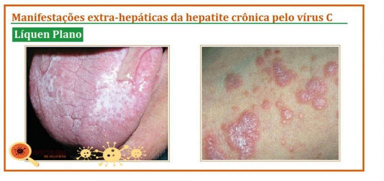 Hepatite C: o que você precisa saber. - Dra keilla Freitas