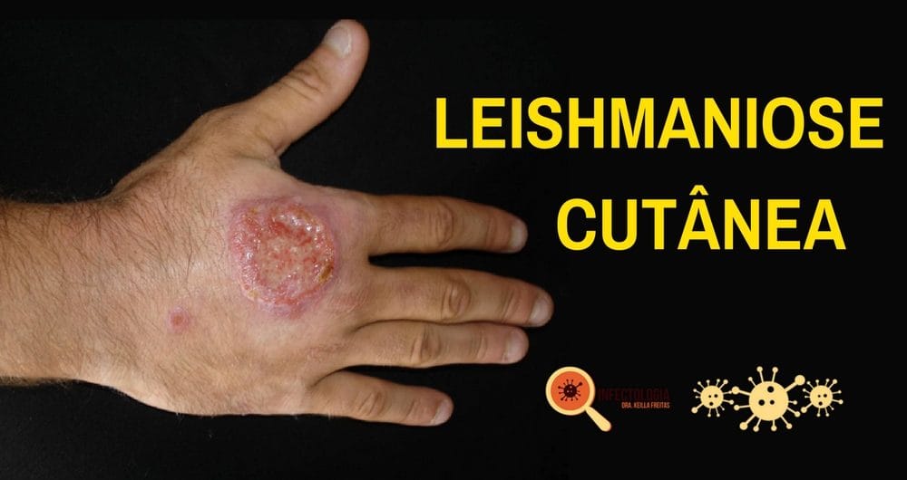 Leishmaniose Cutânea - Dra keilla Freitas