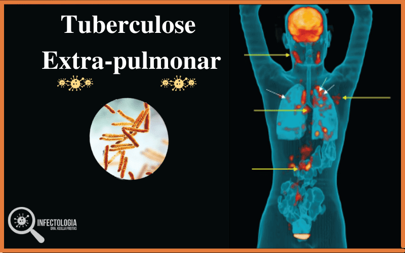 Conheça os Tipos de Tuberculose Extrapulmonar | Dra. Keilla Freitas ...