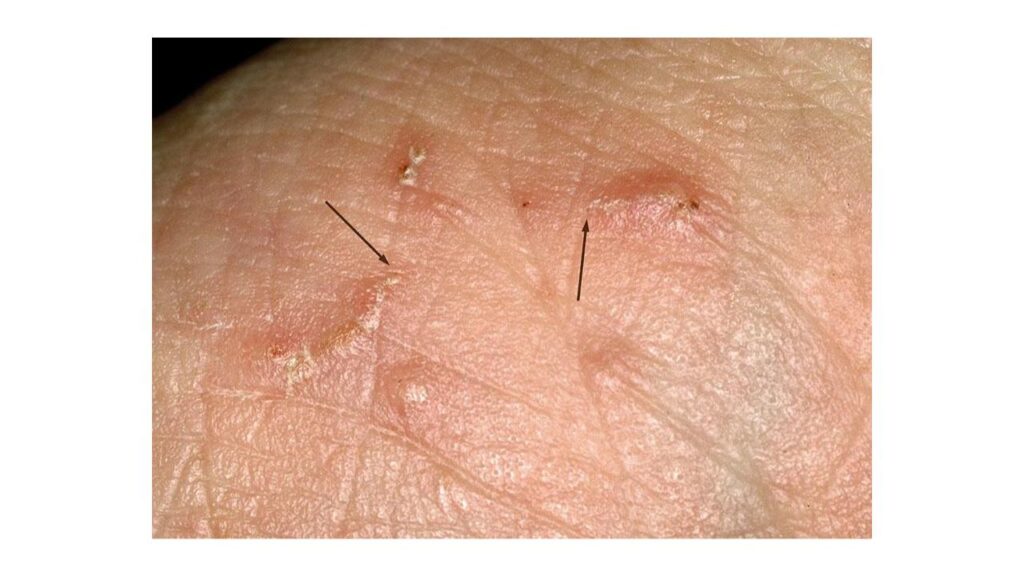 Quais os Perigos da Escabiose (Sarna Humana)?