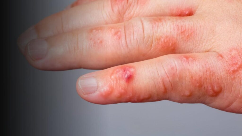 Quais os Perigos da Escabiose (Sarna Humana)?