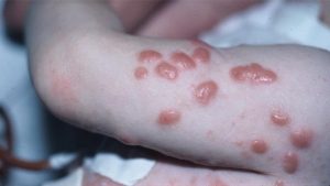 Quais os Perigos da Escabiose (Sarna Humana)? - Dra keilla Freitas