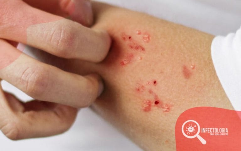 Quais os Perigos da Escabiose (Sarna Humana)? - Dra keilla Freitas