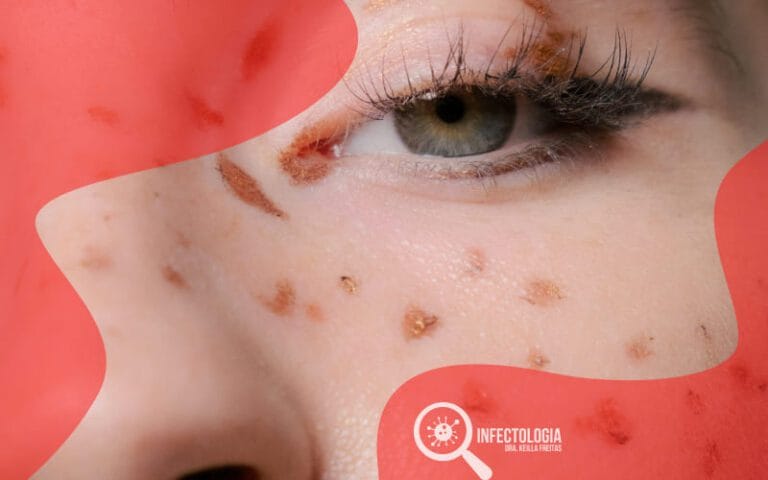 Criptococose em Pessoas com HIV | Dra. Keilla Freitas Infectologista ...